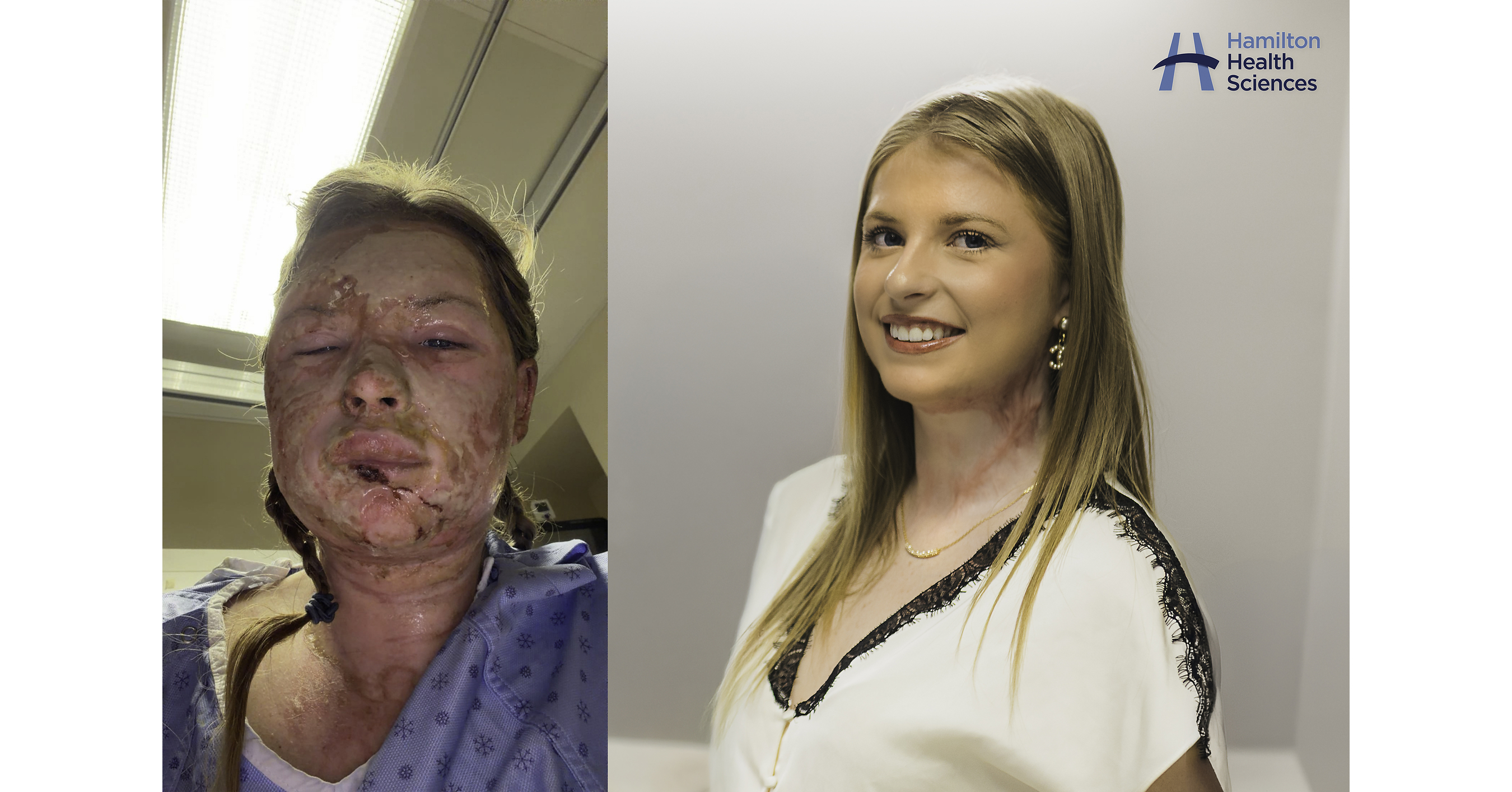World-first burn treatment with "absolutely remarkable" results ...