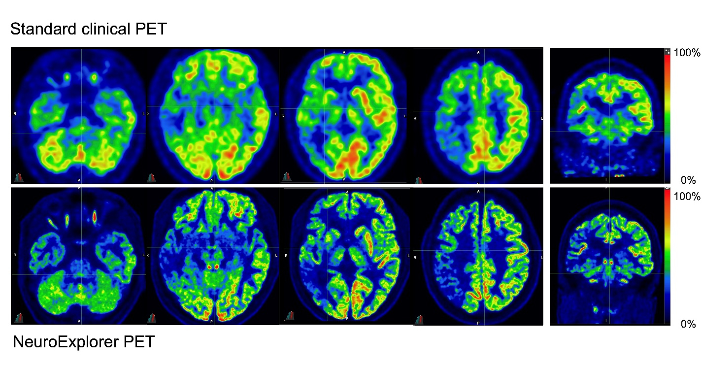 UZ and KU Leuven: NeuroEXPLORER PET makes detection of early phases of ...