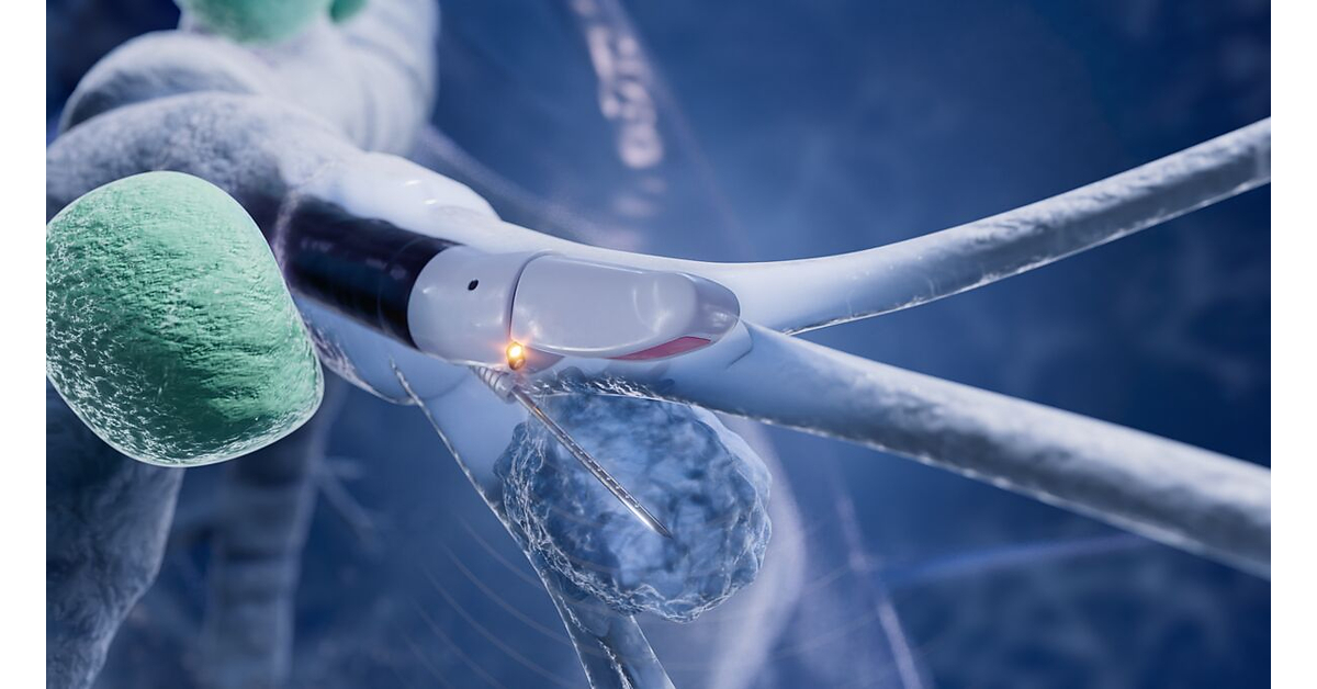 Olympus Announces U.S. Launch of New Peripheral EBUS Bronchoscope